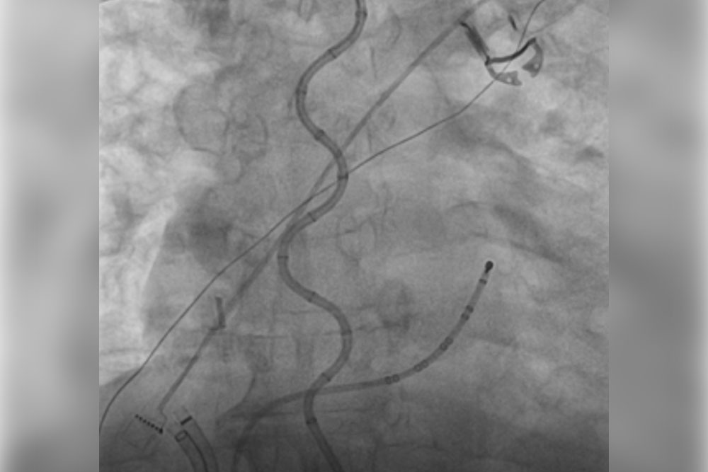Response Times | CIRCA’s S-CATH™ Features